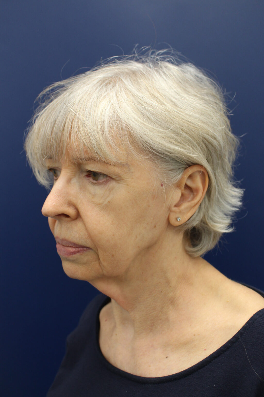 Facelift in Houston | Heights Plastic Surgery