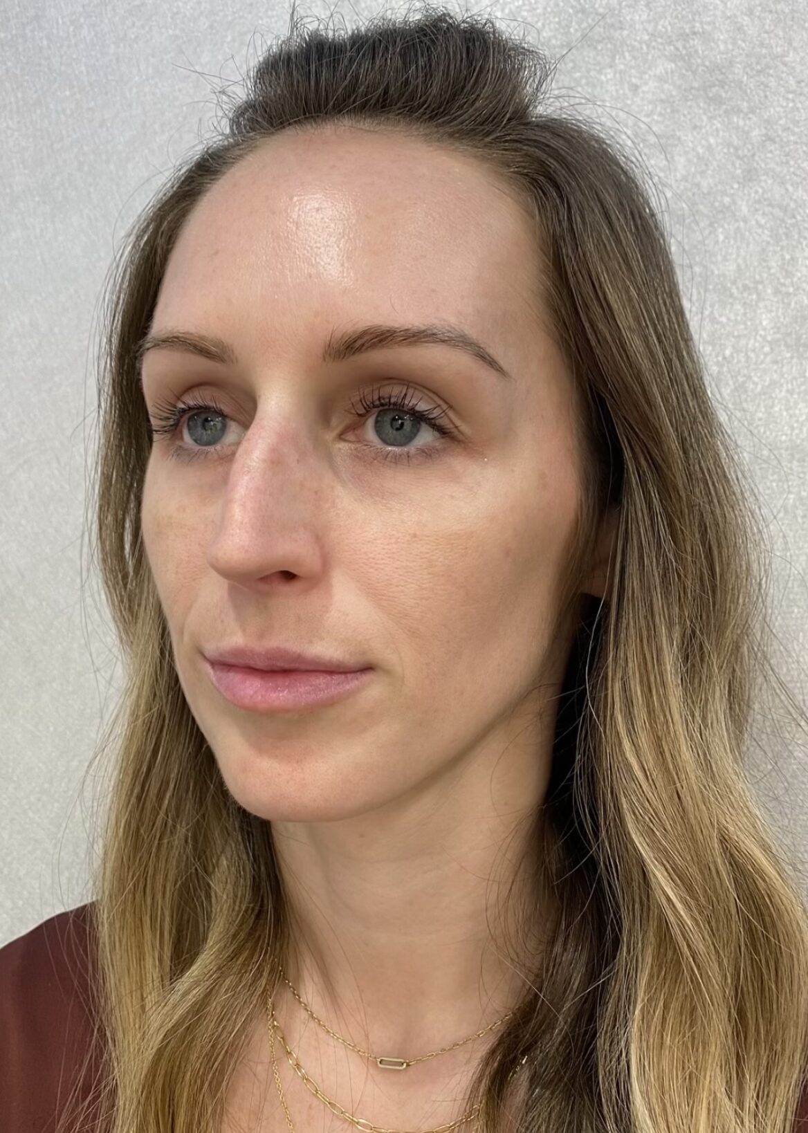 Sculptra 2 - Heights Plastic Surgery